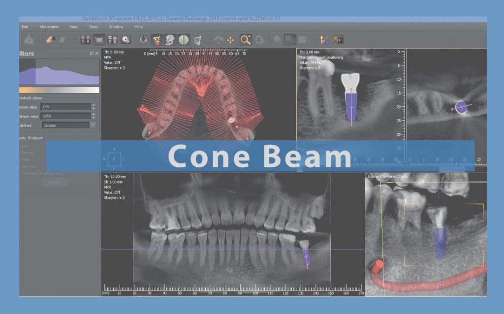 CBCT : Cone beam computed tomography for dental implants surgery – Health Equipment